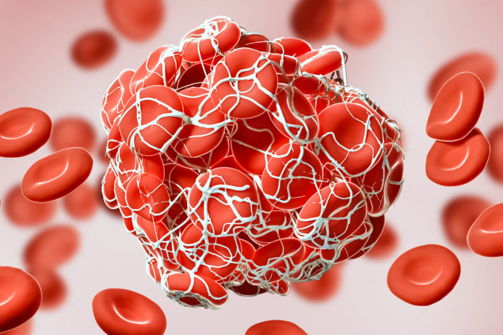 Trombose: conheça 5 hábitos que favorecem e previnem a doença | Jovem Pan